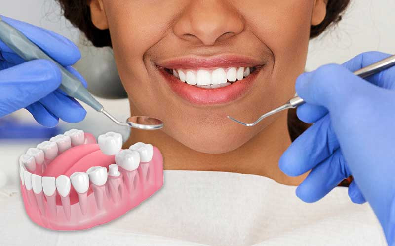 What Patients Should Know About Today's Most Common Dental Crown ...
